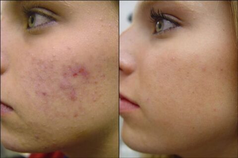 Acne Scars - Causes, Prevention, and Treatment | Waxelene